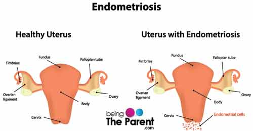 Cyst In Fallopian Tube