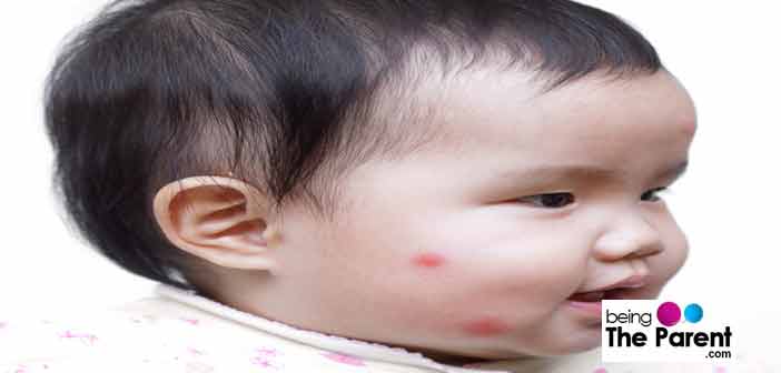 Bites, Cuts And Scratches - First Aid Guide For Kids - Being The Parent