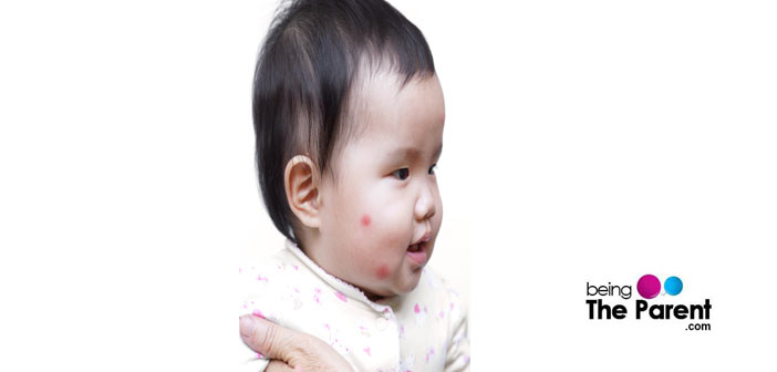 Mosquito Bites In Babies - Causes, Remedies, Treatment and Prevention ...