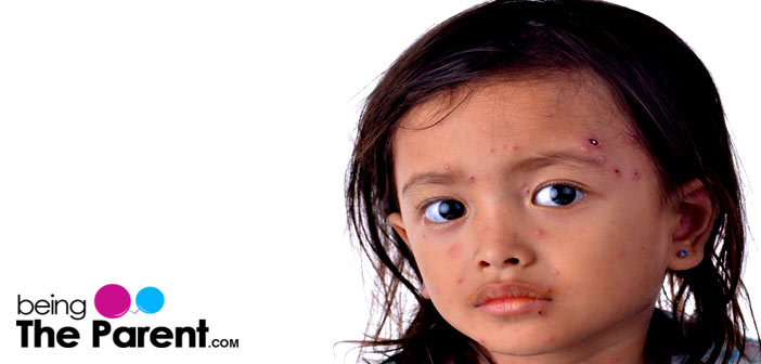 Chickenpox- Causes, Symptoms, Treatment, Home Remedies - Being The Parent