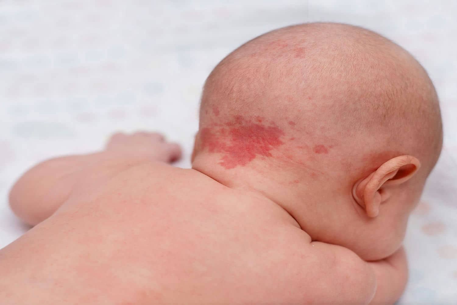 What Are Birthmarks? What Are Their Different Types? - Being The Parent