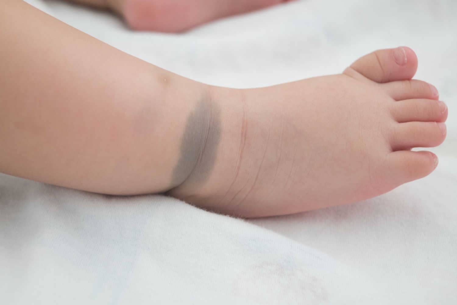 What Are Birthmarks? What Are Their Different Types? - Being The Parent