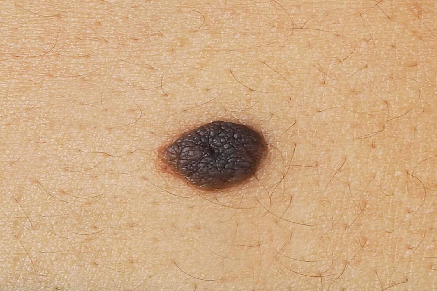 What Are Birthmarks? What Are Their Different Types? - Being The Parent