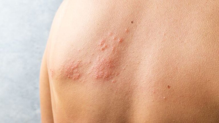 Shingles In Toddlers - Causes, Symptoms, And Treatment - Being The Parent