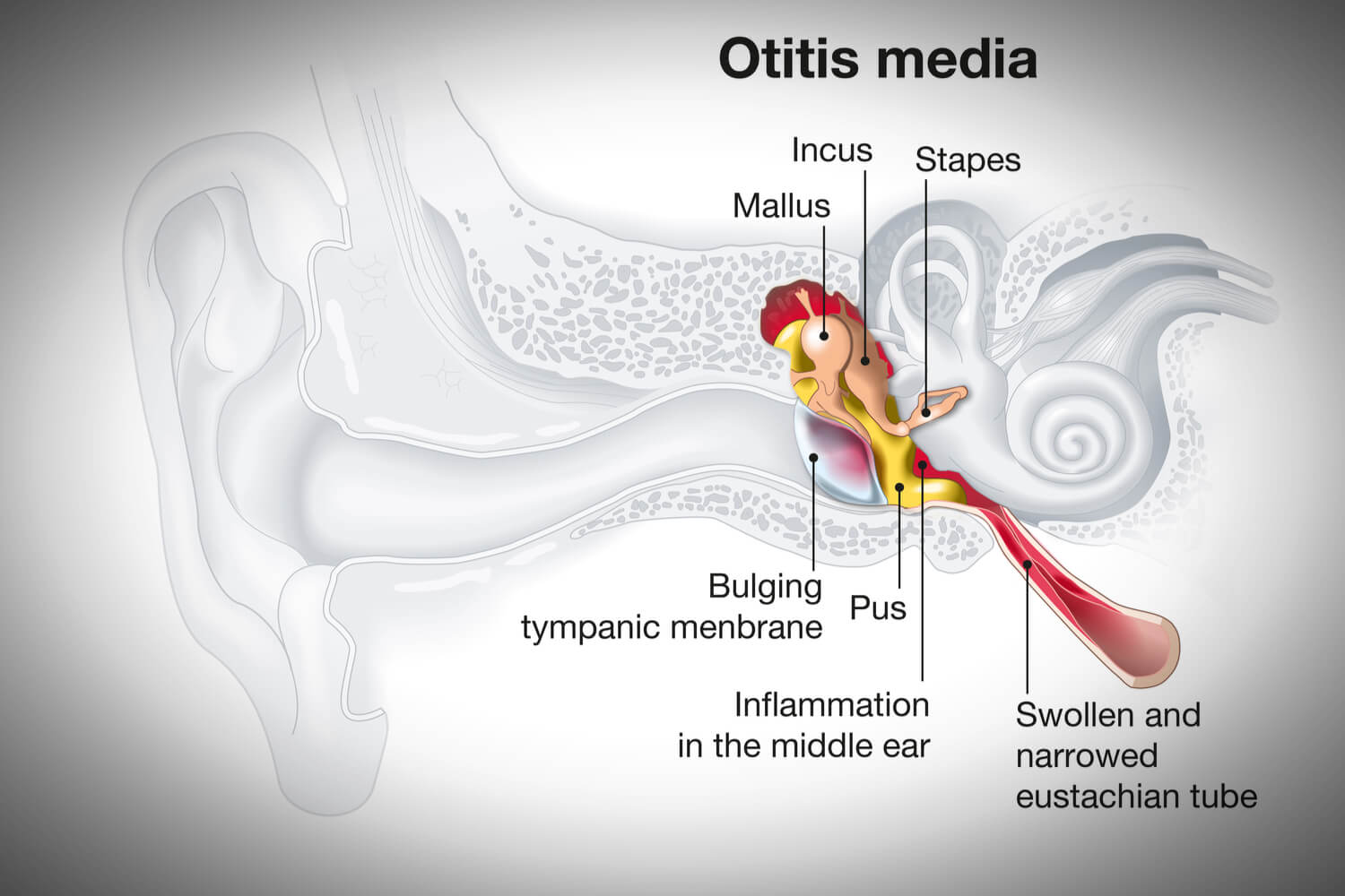Ear Infection In Babies - Types, Causes, Symptoms & Treatment - Being ...