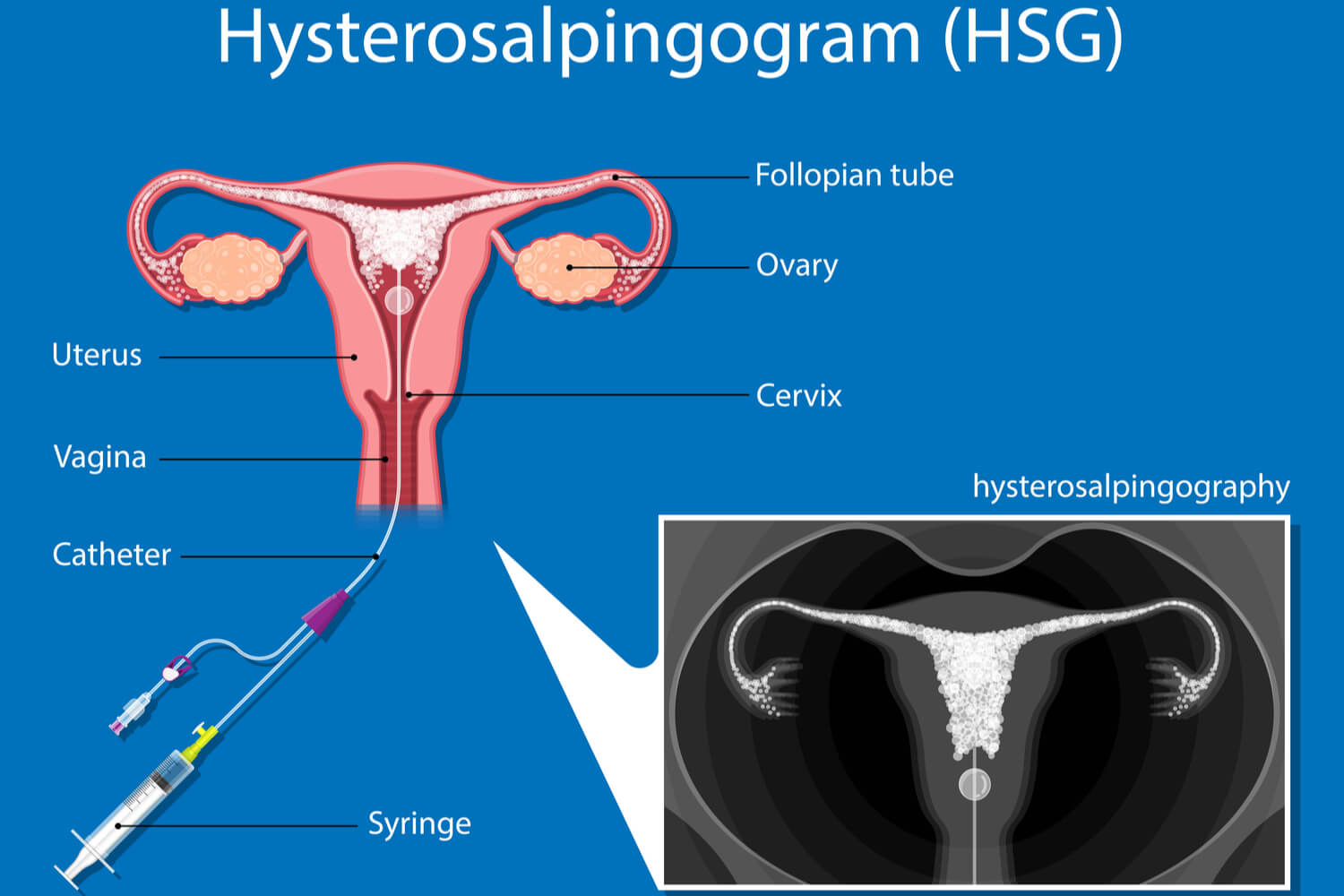 Blocked Fallopian Tubes - Types, Causes And Treatments - Being The Parent