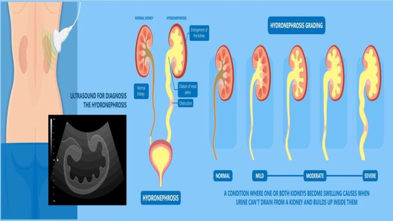 Fetal Kidney Problem - Types, Causes & Treatment - Being The Parent