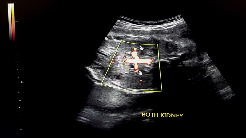 Fetal Kidney Problem - Types, Causes & Treatment - Being The Parent