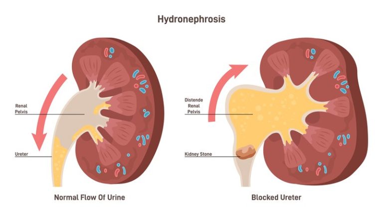 Fetal Kidney Problem - Types, Causes & Treatment - Being The Parent