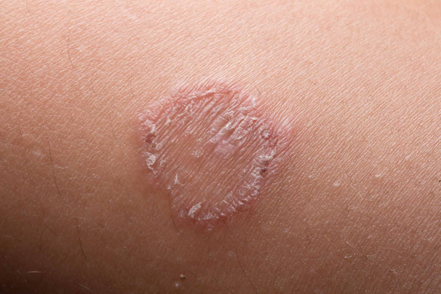 Ringworm In Babies– Causes, Symptoms And Treatment - Being The Parent