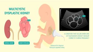 Fetal Kidney Problem - Types, Causes & Treatment - Being The Parent