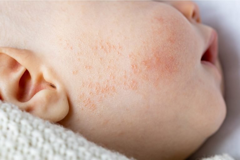 8 Common Skin Problems in Babies and Their Solutions - Being The Parent