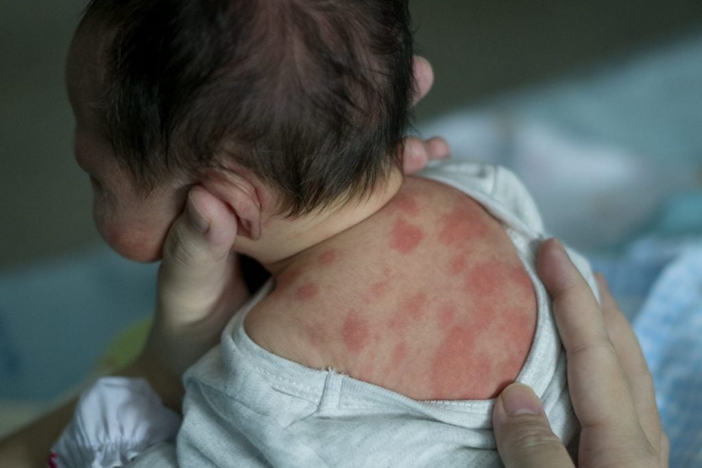 8 Common Skin Problems in Babies and Their Solutions - Being The Parent