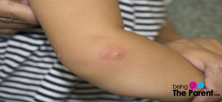 How To Treat 'Bee Sting' In Children? - Being The Parent