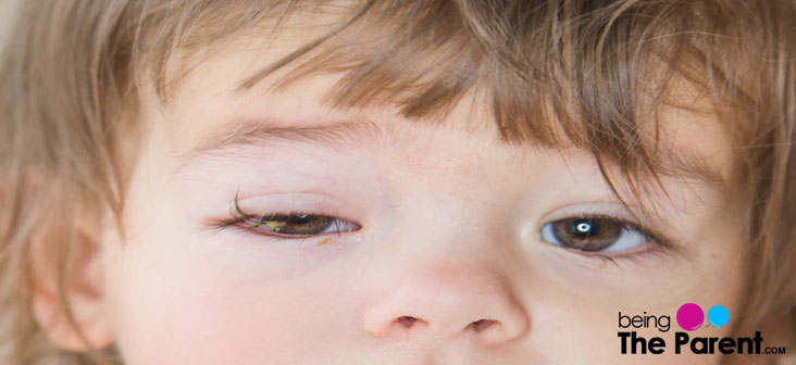 Pinkeye (Conjunctivitis) In Babies – Causes, Symptoms And Treatment ...