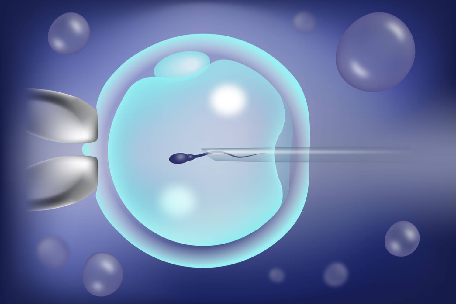 Fertility Treatment With In Vitro Maturation(IVM) - Being The Parent