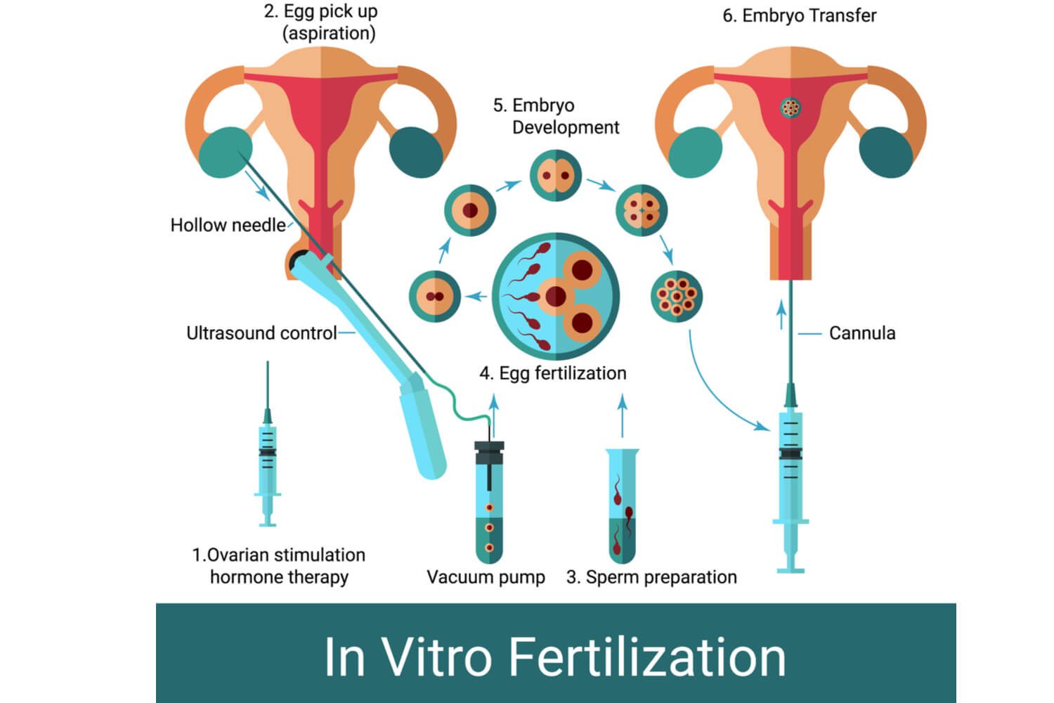 In Vitro Fertilization (IVF) Process, Cost and Success Rate - Being The ...