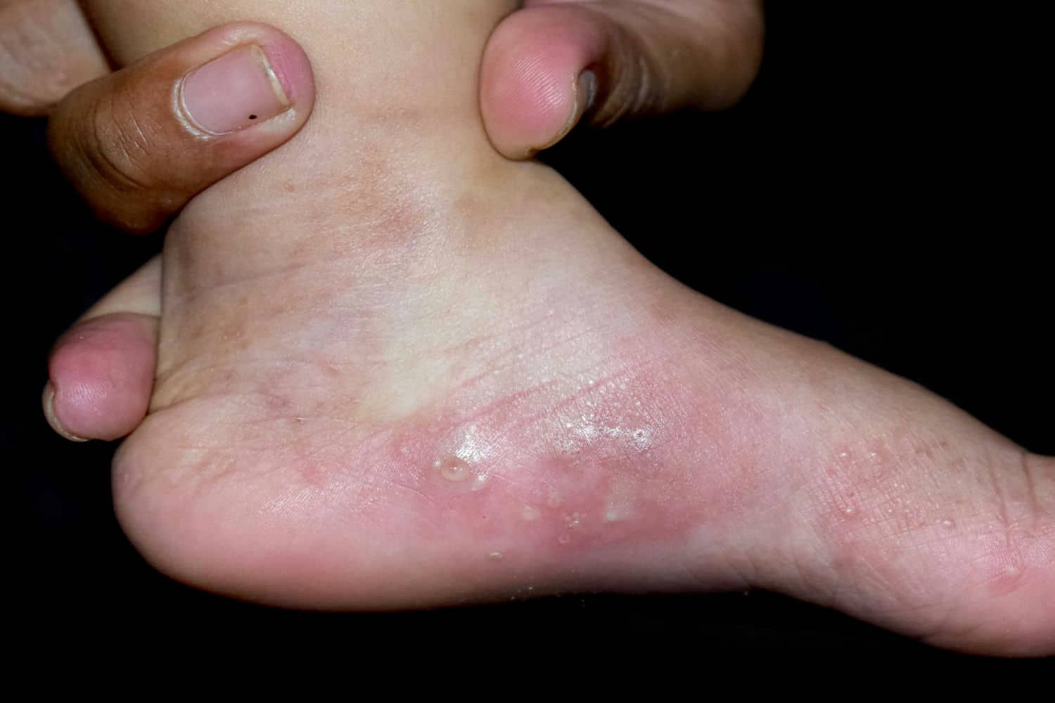 Scabies In Babies: Causes, Symptoms And Treatment - Being The Parent