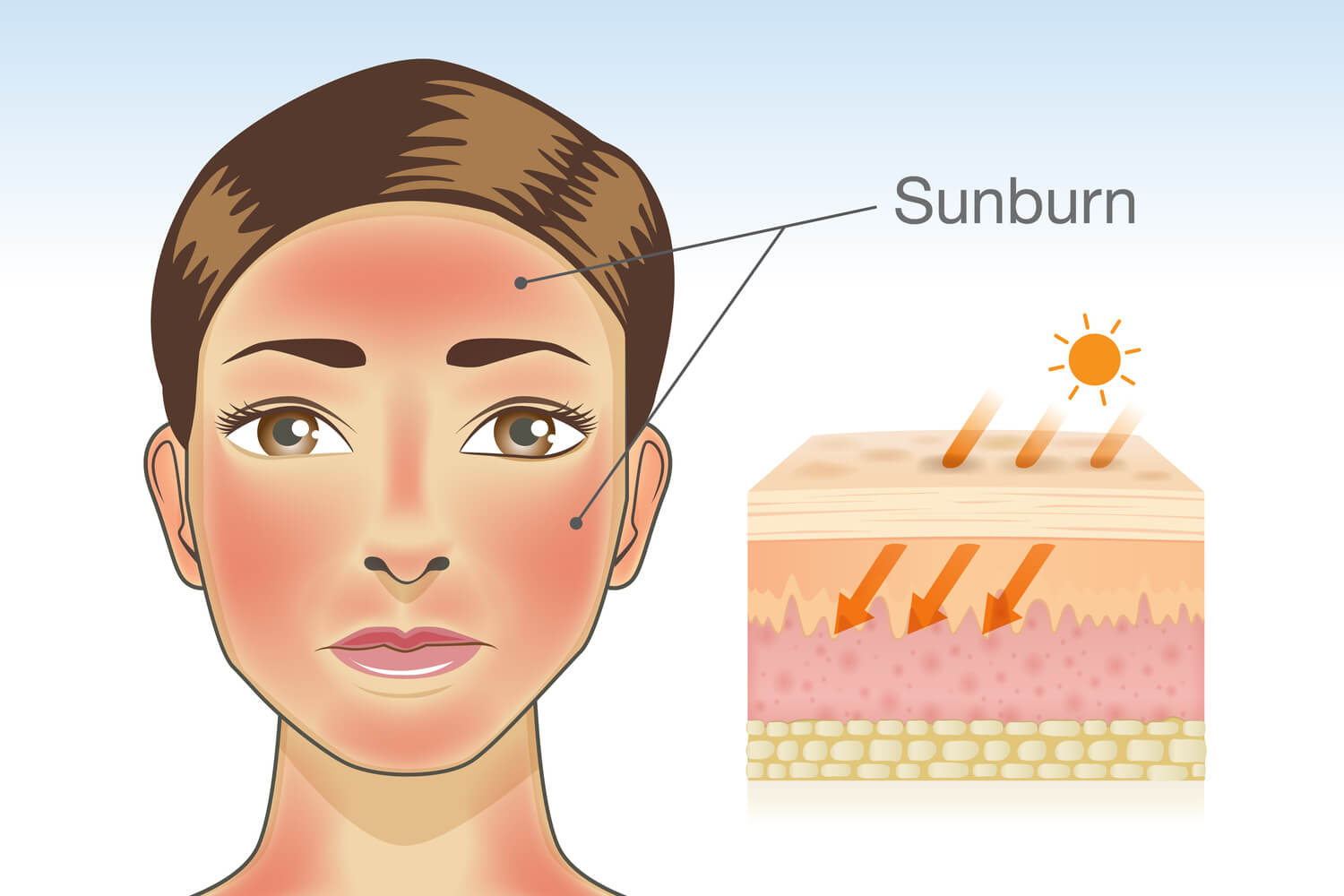 Sunburn In Babies: Signs, Treatment And Prevention - Being The Parent