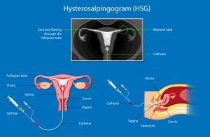 Chances Of Getting Pregnant After Hysterosalpingogram (HSG )Test ...