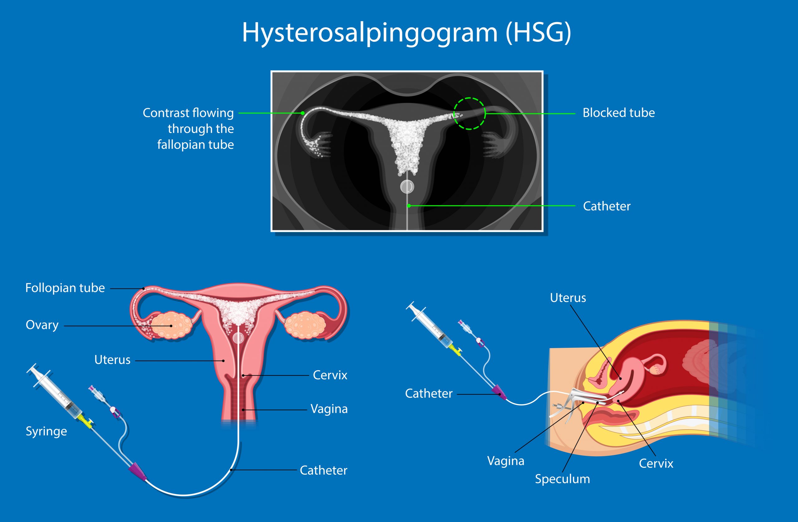 Chances Of Getting Pregnant After Hysterosalpingogram (HSG )Test ...