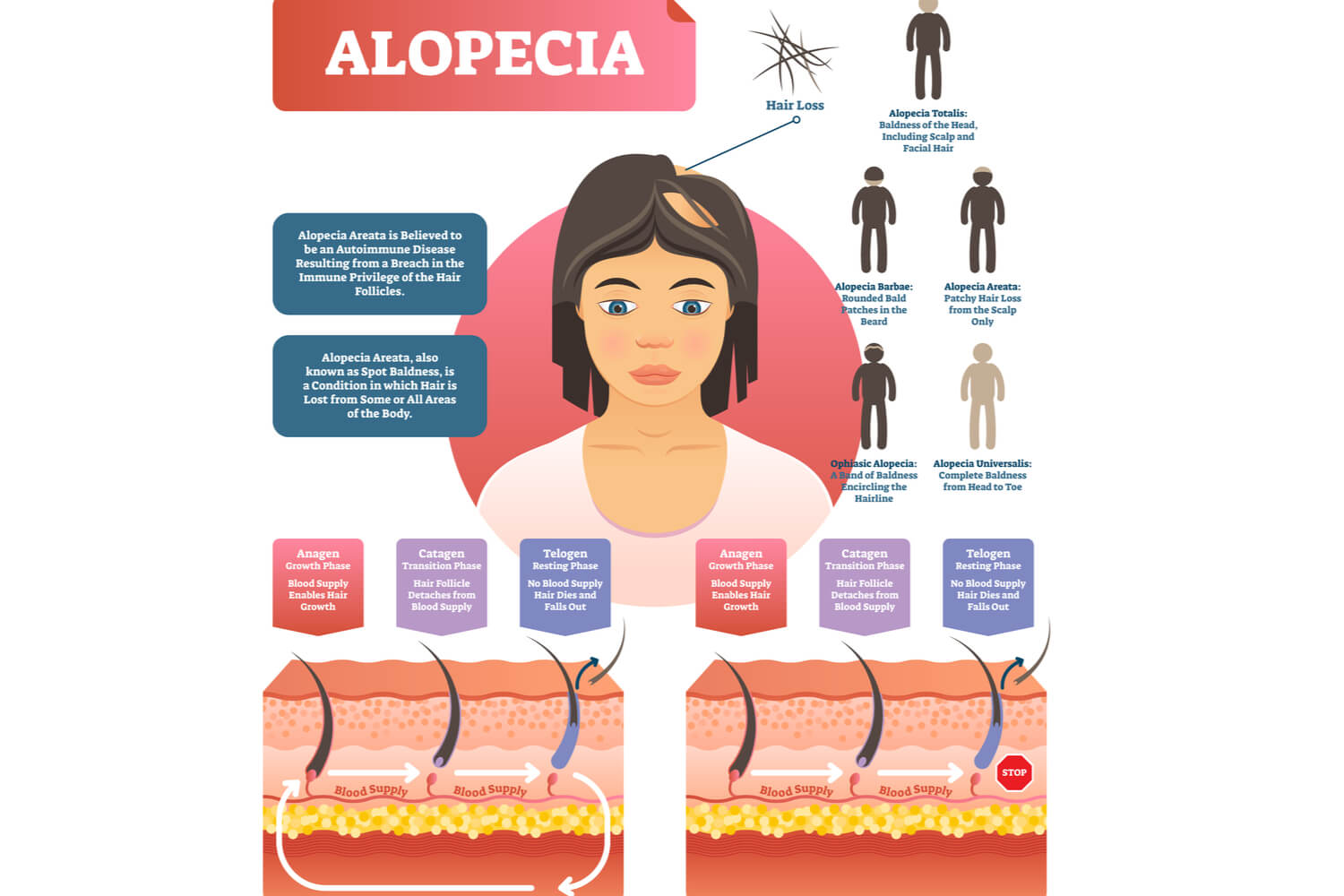 Alopecia Areata in Children: Causes & Treatment - Being The Parent