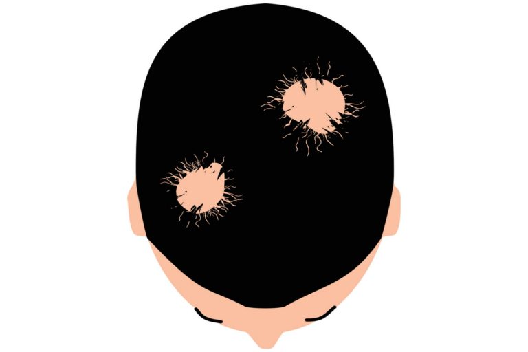 Alopecia Areata in Children: Causes & Treatment - Being The Parent