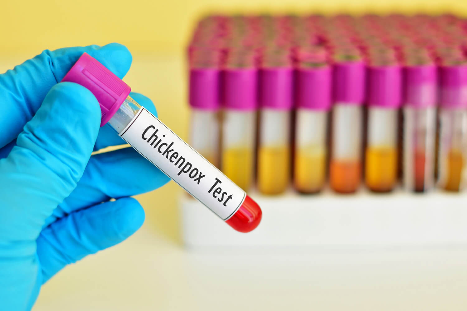Breastfeeding During Chickenpox- Safety & Precautions - Being The Parent