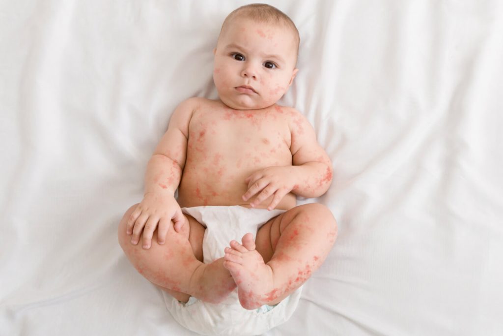 Viral Rashes in Babies – Types, Symptoms and Treatment - Being The Parent