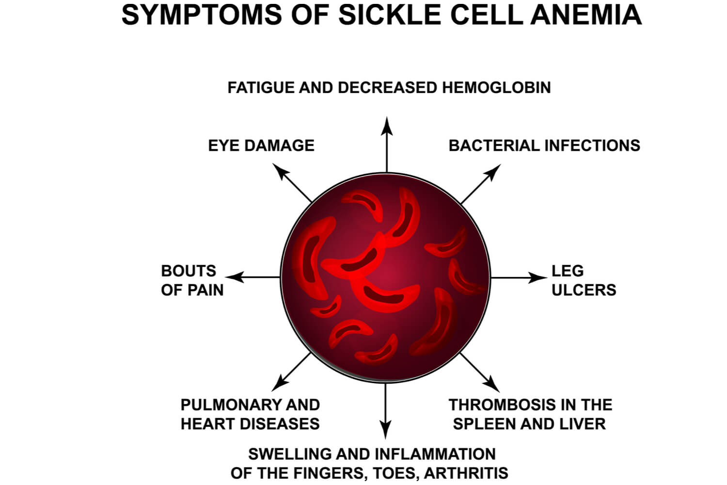 Sickle Cell Disease in Children: Symptoms, Diagnosis, Prevention