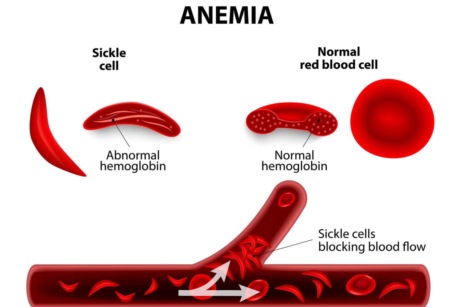 Sickle Cell Disease in Children: Symptoms, Diagnosis, Prevention