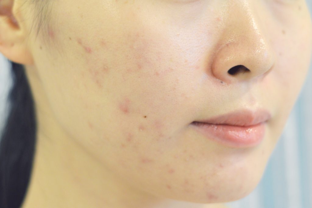 Dealing With Skin Breakouts During Pregnancy - Being The Parent