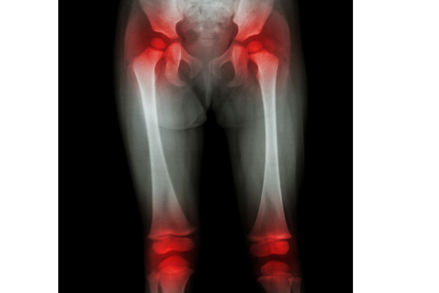 How Important is Physiotherapy For Juvenile Idiopathic Arthritis?