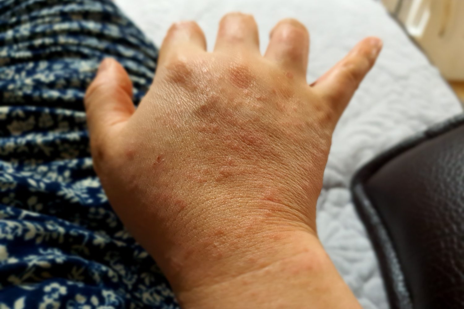 When Should You Consider Seeing a Dermatologist During Pregnancy ...