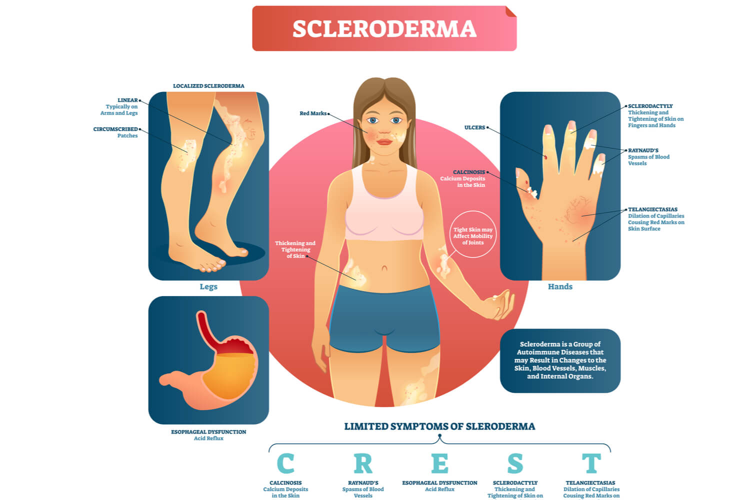 My Child is Diagnosed With Scleroderma – What Should I Do? by Dr. Sagar ...
