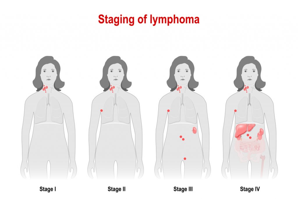Lymphoma in Children - Being The Parent