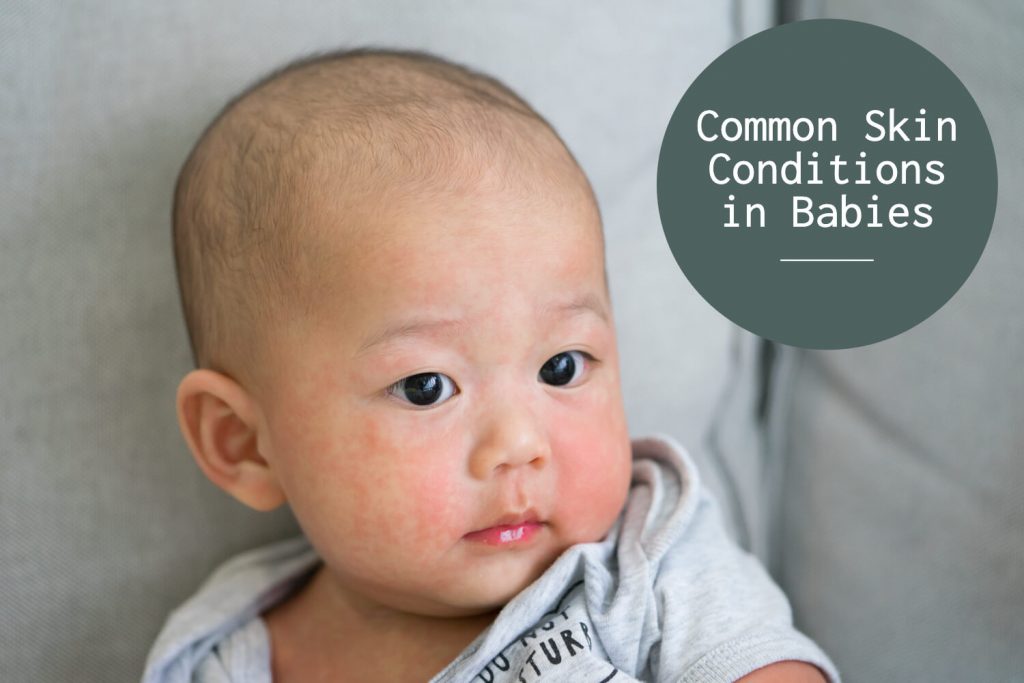Common Skin Conditions in Babies - Prevention and Remedies - Being The Parent