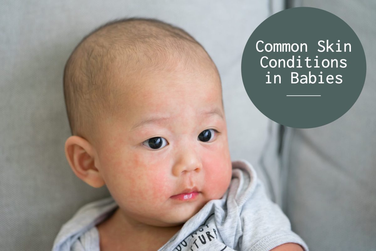 Common Skin Conditions in Babies - Prevention and Remedies - Being The ...