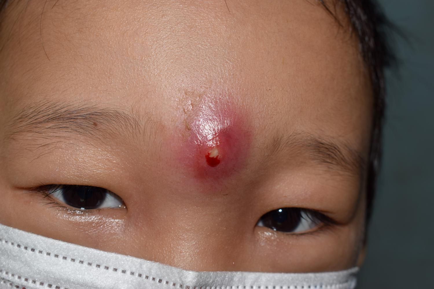 Pediatric Chronic Granulomatous Disease By Dr Sagar Bhattad Being pediatric-chronic-granulomatous-disease-by-dr-sagar-bhattad-being