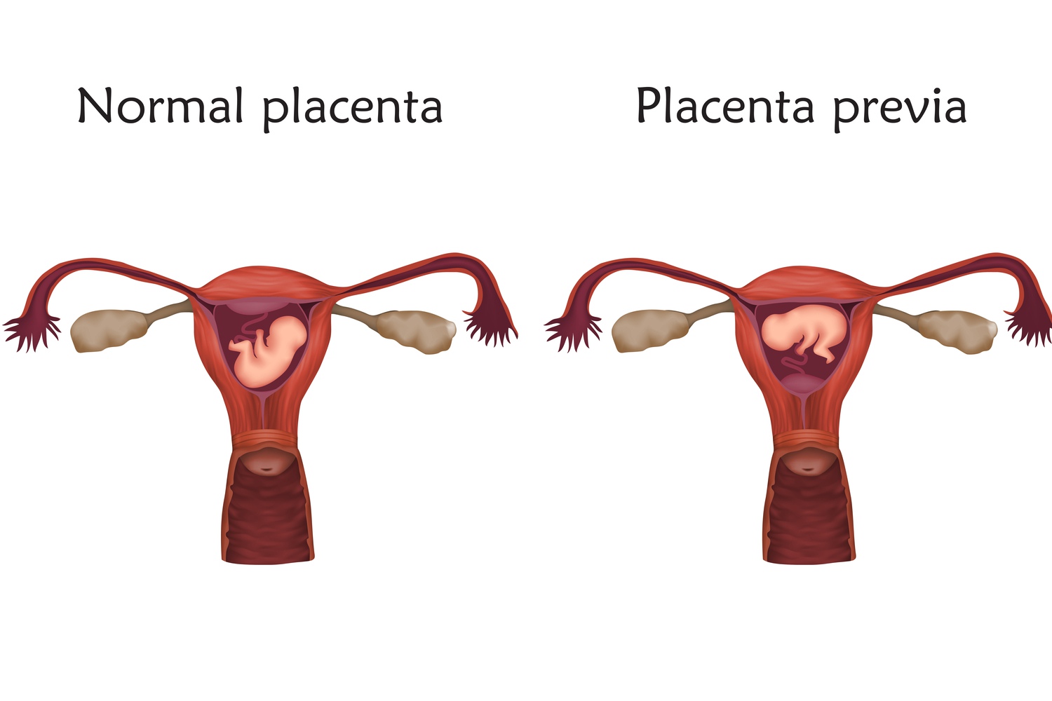 Vasa Previa in Pregnancy - Causes, Symptoms and Treatment - Being The ...