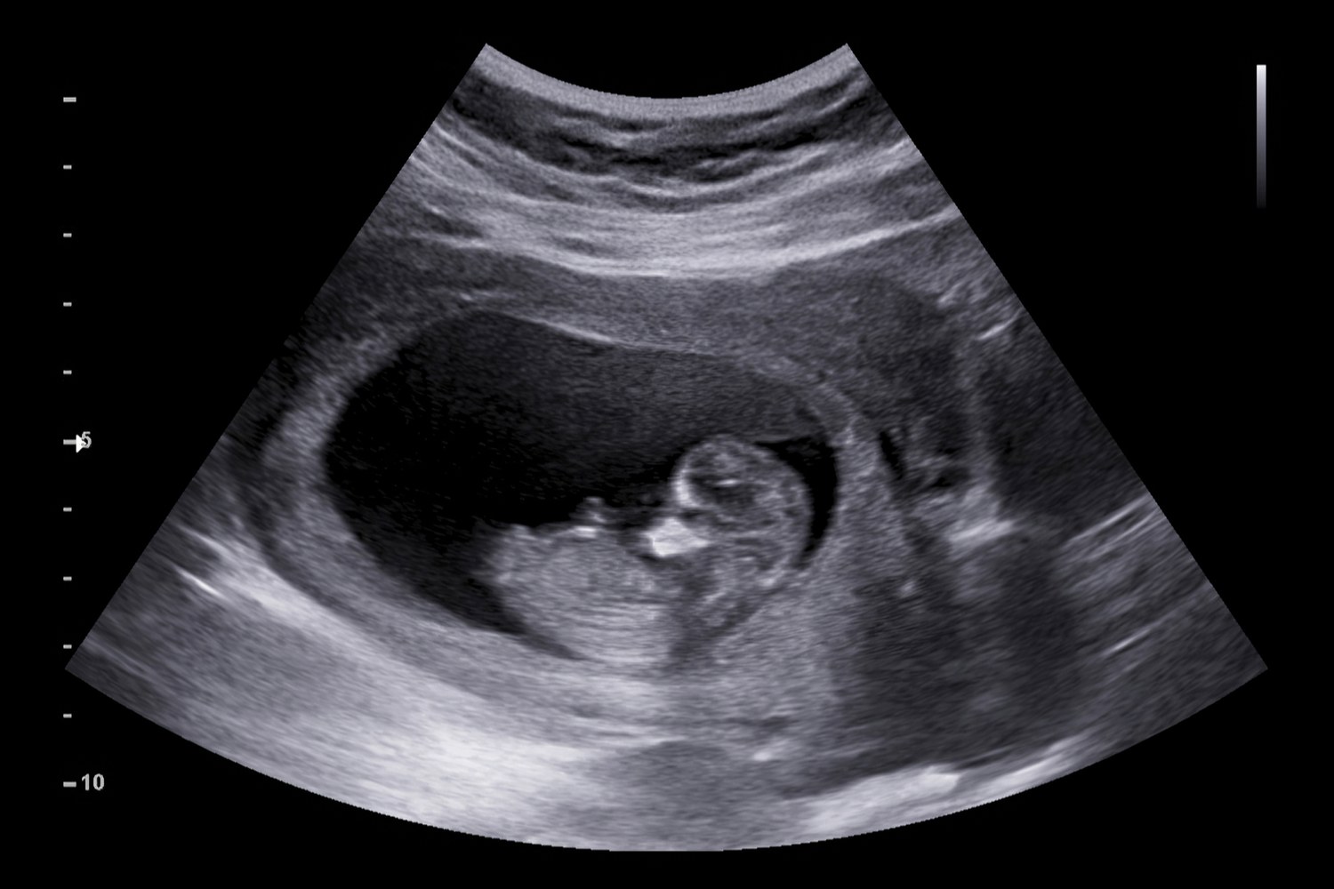 Can You Predict Baby's Sex Using Nub Theory? - Being The Parent Can You Predict Baby's Sex Using Nub Theory? - Being The Parent