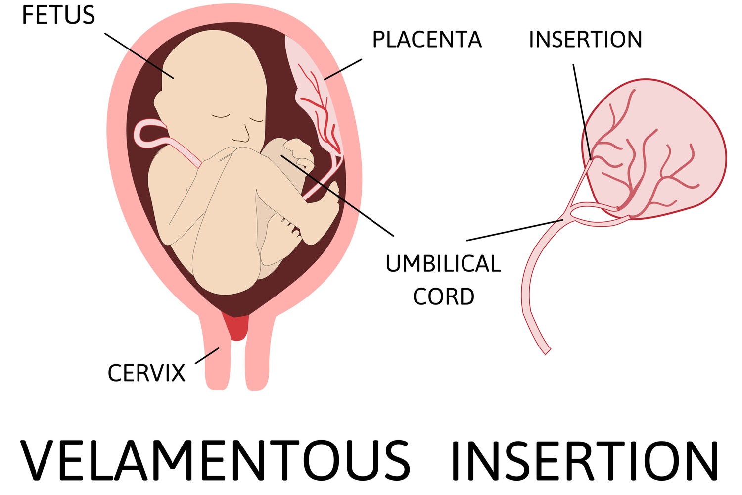 Vasa Previa In Pregnancy Causes Symptoms And Treatment Being The