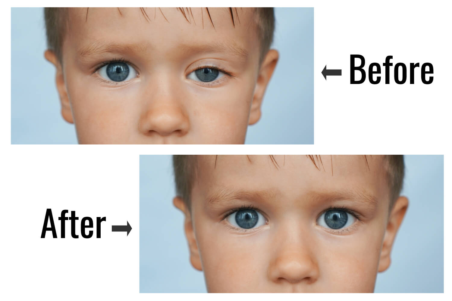 Congenital Ptosis in Babies - Causes, Symptoms, and Treatment - Being ...