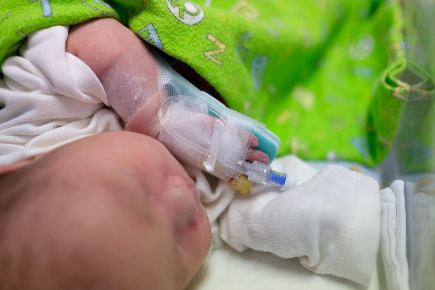 Neonatal Progeroid Syndrome - Causes, Symptoms, And Treatment - Being ...