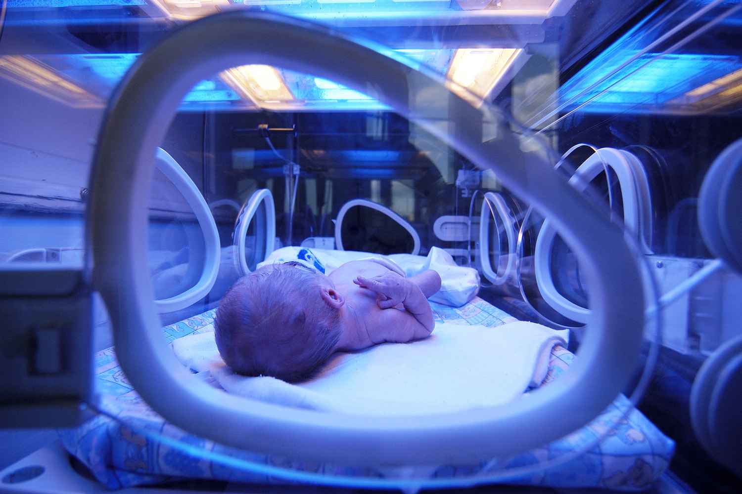 Neonatal Abstinence Syndrome - Symptoms, Causes and Treatment by Dr ...