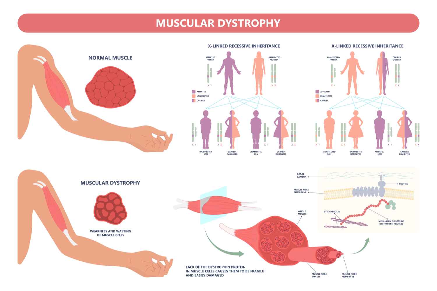 Congenital Muscular Dystrophy in Babies - Causes, Symptoms and ...