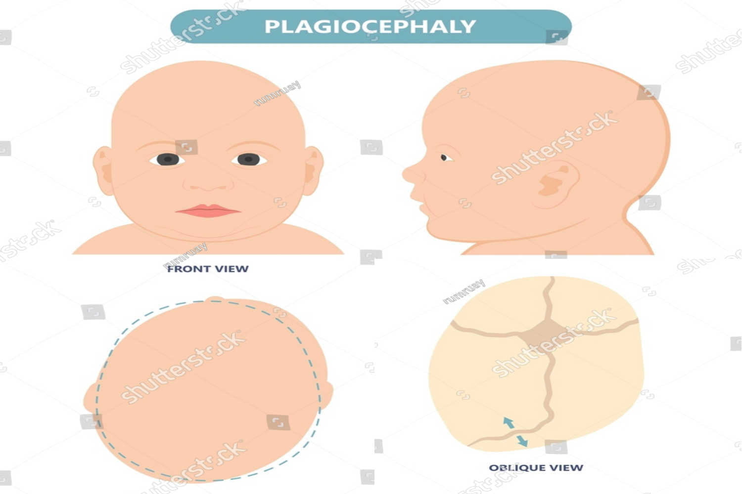 Flat Head Syndrome In Babies - Causes, Symptoms And Treatment Options ...