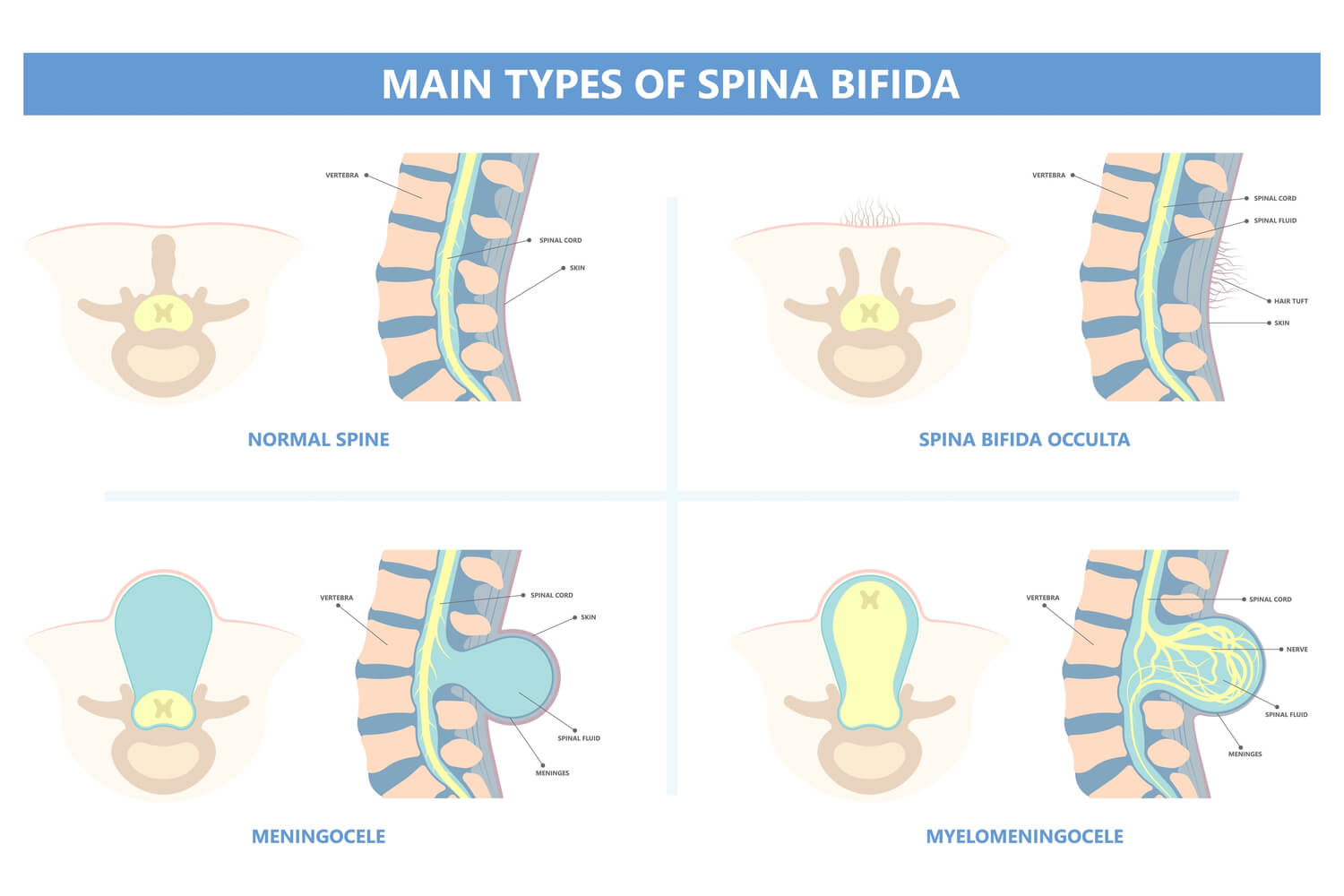 Spina Bifida in Babies - Symptoms, Diagnosis And Treatment - Being The ...