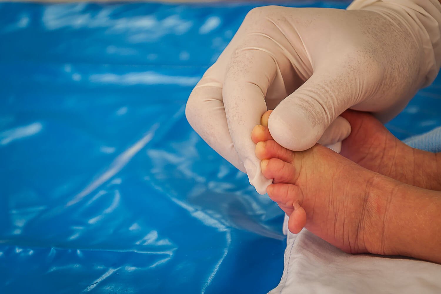 Polydactyly(Extra Fingers) in Babies - Causes, Symptoms And Treatment ...