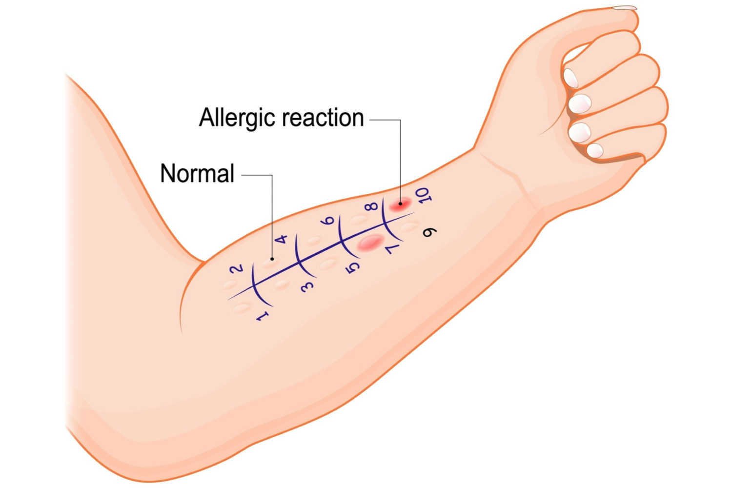 Peanut Allergy in Babies - Signs, Causes and Treatment - Being The Parent